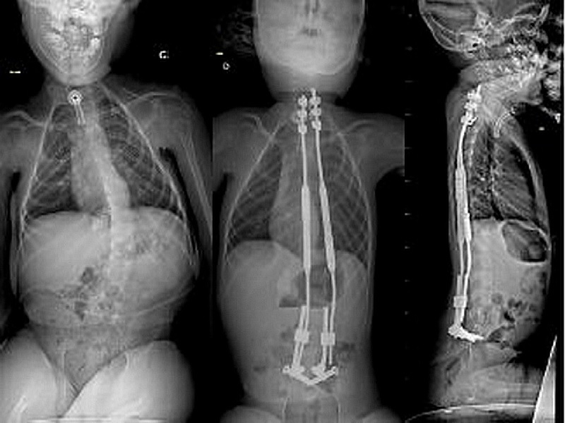 Chirurgie de la scoliose Turquie, Prix & Cliniques